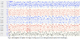 Unusual-Electrographic-Findings-Of-Lithium-Toxicity