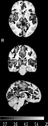 SIMULTANEOUS-EEG-AND-FMRI-OF-VERTEX-SHARP-TRANSIENTS