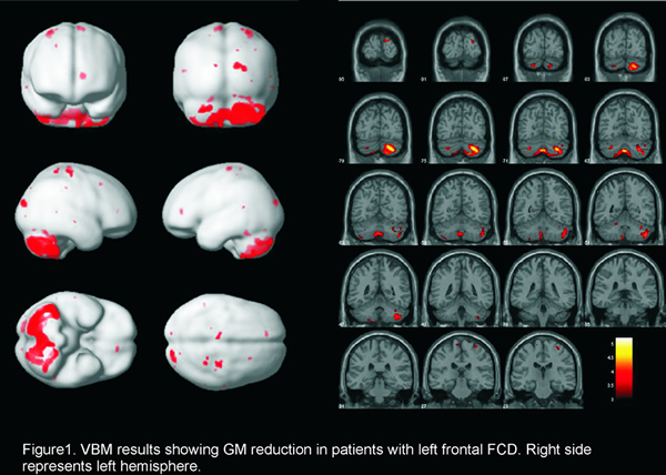 VBM-and-Cortical-analysis-in--focal-cortical-dysplasia-reveal-areas ...