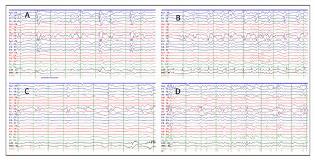 DRUG-INDUCED-EEG-PATTERN-PREDICTS-EFFECTIVENESS-OF-KETAMINE-IN-TREATING ...