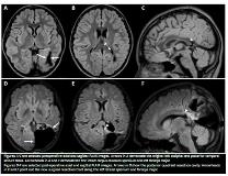 ALEXIA-WITHOUT-AGRAPHIA-IN-A-CHILD---AN-UNUSUAL-COMPLICATION-OF ...