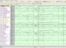 EYE-CLOSURE-SENSITIVITY-IN-AN-ADULT-WITH-SUSPECTED-TEMPORAL-LOBE-EPILEPSY