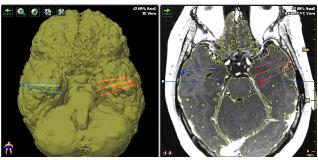 FRAMELESS-IMAGE-GUIDED-STEREOTACTIC-IMPLANTATION-OF-DEPTH-ELECTRODES ...
