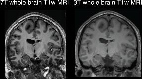 7T-whole-brain-MRI-provides-increased-statistical-power-for ...