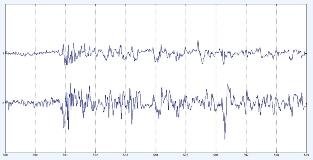 Intravascular-EEG-in-rats--proof-of-concept