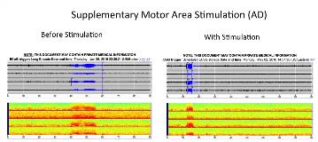 Novel-multimodal-surgical-interventions-achieve-Engel-Class-II-outcome ...