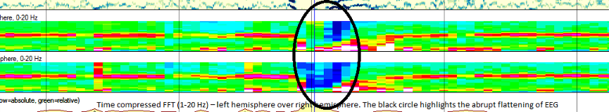 Convulsive-syncope--Simultaneous-Video-EEG-and-EKG-monitoring