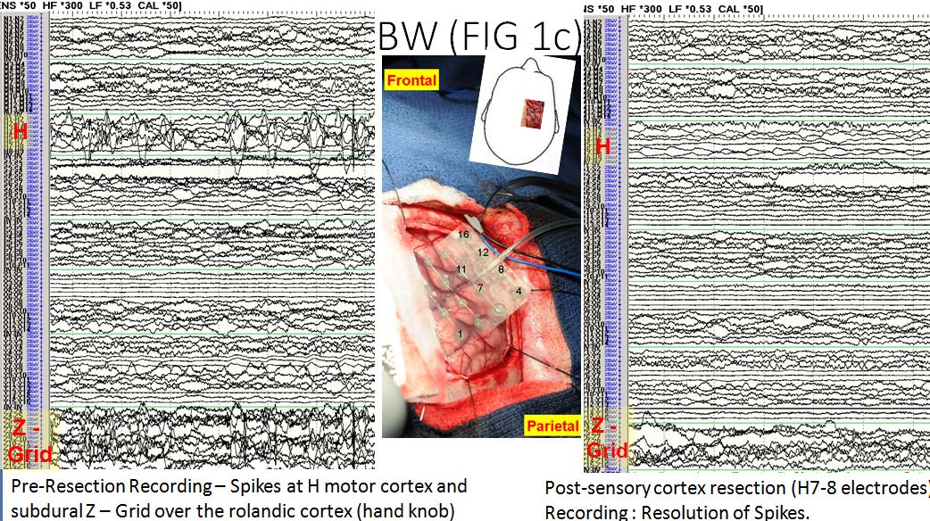Role-of-multimodal-extraoperative-and-intraoperative ...