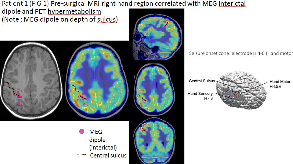 Role-of-multimodal-extraoperative-and-intraoperative ...