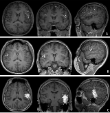 The-Role-of-Magnetoencephalography-in-Presurgical-Evaluation-of ...