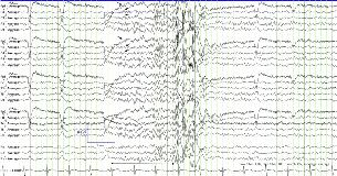Electroclinical-Features-and-Incidence-of-Generalized-Paroxysmal-Fast ...