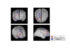 Two-Step-Combined-Stereo-EEG-and-Chronic-Subdural-EEG-Recording-for ...