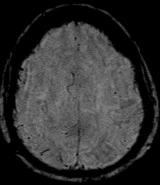 SMART-Syndrome-as-an-Unusual-Presentation-of-Convulsive-Status-Epilepticus