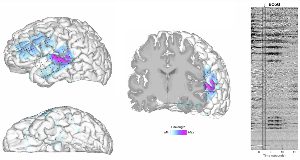 Cinematic-Projection-of-Ictal-Activity-on-Three-Dimensional-Brain ...