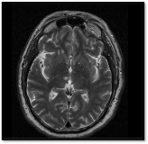 Unprecedented-Manifestation-of-Multisensory-Hallucinations-in-Epilepsy