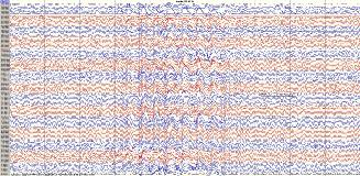 Transient-Frontal-Intermittent-Rhythmic-Delta-Activity-(FIRDA)-Observed ...