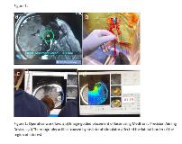 MRI-Guided-Laser-Therapy-for-Refractory-Focal-Epilepsy-in-a-Patient ...