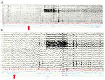 The-Role-of-the-Amygdala-in-Ictal-Central-Apnea--New-Insights-from-Long ...