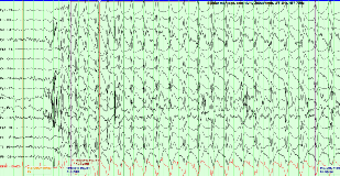 Head-Bobbing-or-Nodding-Seizures--A-Fascinating-but-Non-specific-Sign