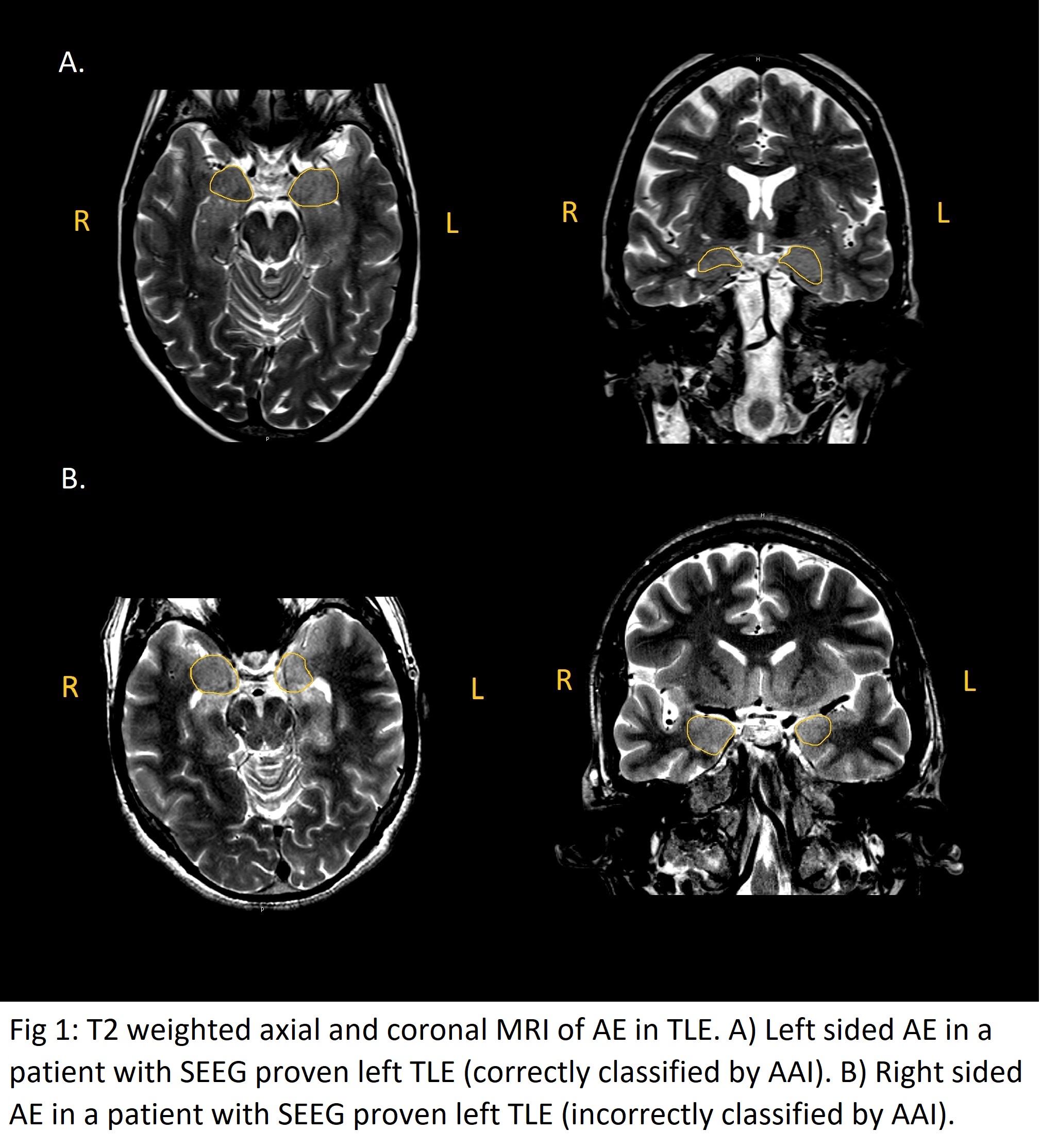 amygdalar asymmetry in temporal lobe epilepsy: mri-seeg study